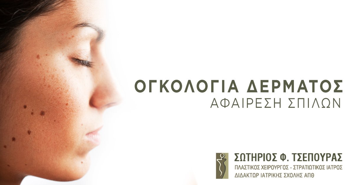 Ογκολογία Δέρματος | Μαλακών Μορίων | Σπίλοι | Dr. Τσέπουρας Σωτήριος