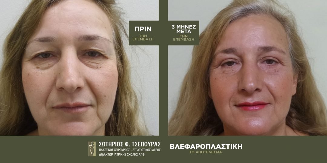 Βλεφαροπλαστική Θεσσαλονίκη Πριν & Μετά | Dr. Τσέπουρας Πλαστικός