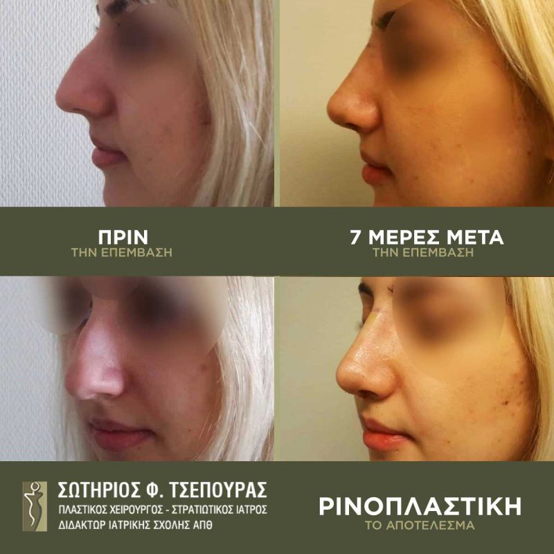 Ρινοπλαστική Θεσσαλονίκη Σε Νεαρή Γυναίκα | Dr. Τσέπουρας Πλαστικός