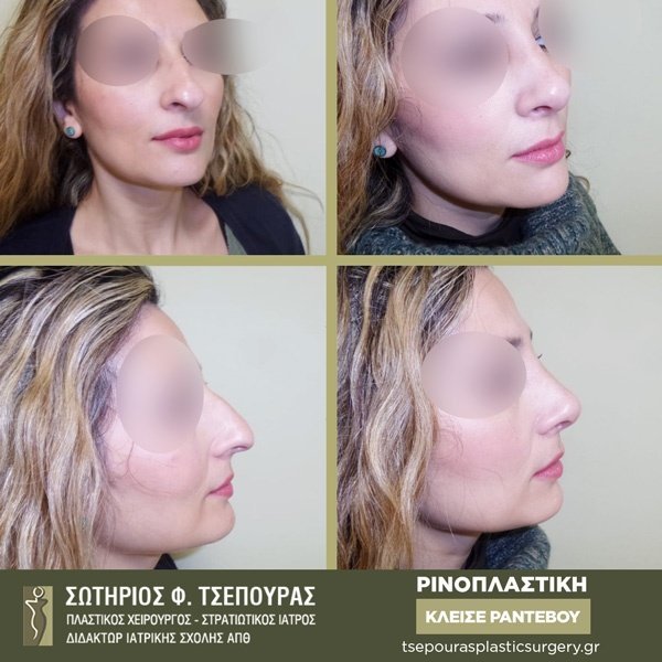 Ρινοπλαστική Θεσσαλονίκη Σε Κοπέλα | Dr. Τσέπουρας Πλαστικός
