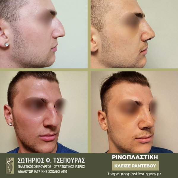 Ρινοπλαστική Στη Θεσσαλονίκη Σε Άντρα | Πλαστικός Dr. Τσέπουρας